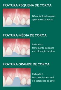 Pino de fibra de vidro: o que é e quais as vantagens? - StudioUno ...