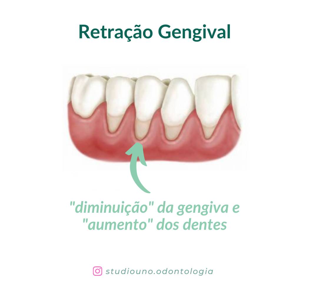 Retração Gengival: conheça as causas e saiba como evitar