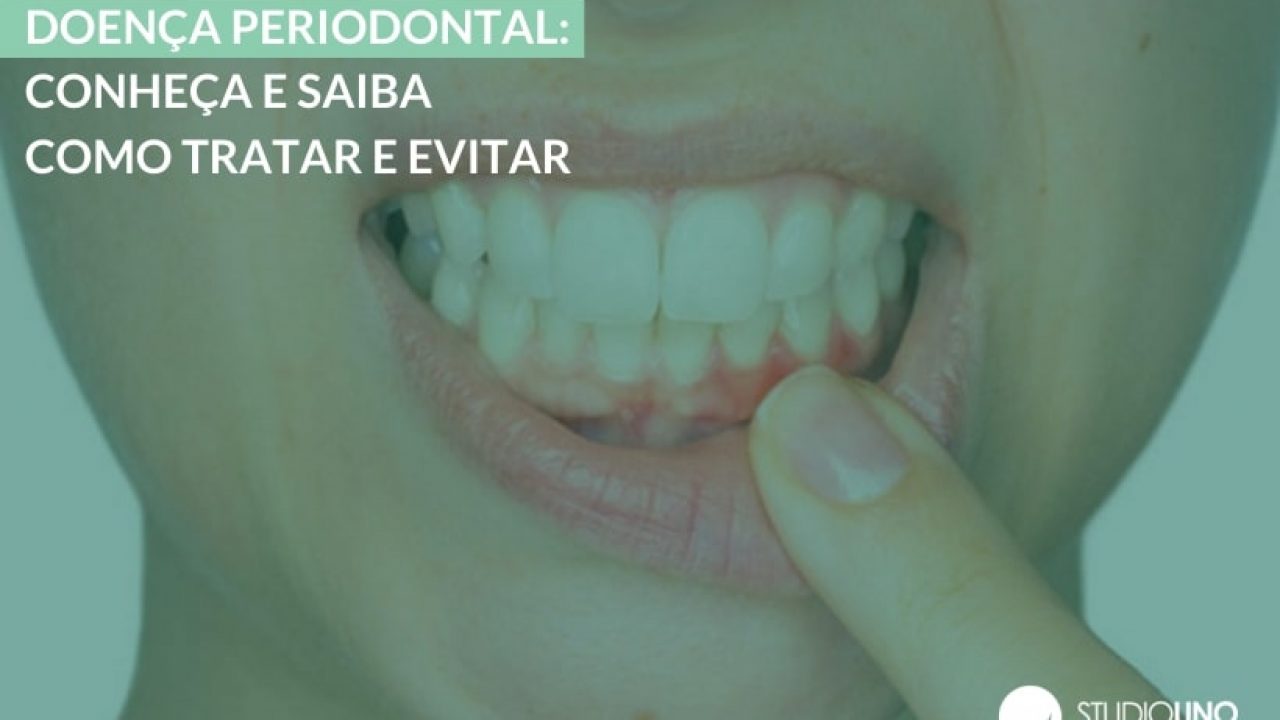 Estagios Da Doenca Gengival Orto Express Odontologia A Doença